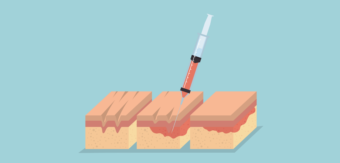 Botulinum Toxin - 보스피부과의원